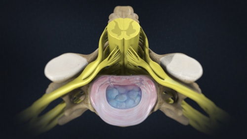 Annular Disc Tear: Treatment in Fairfax, VA | SAPNA: Spine and Pain ...