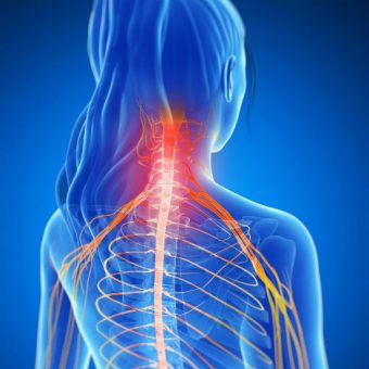 Pinched Spinal Nerve (Cervical Radiculopathy): Treatment in Fairfax, VA | SAPNA: Spine and Pain ...