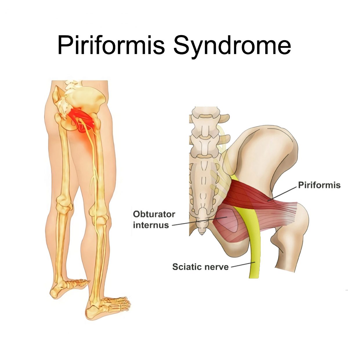 Piriformis Syndrome Treatment In Fairfax VA SAPNA Spine And Pain