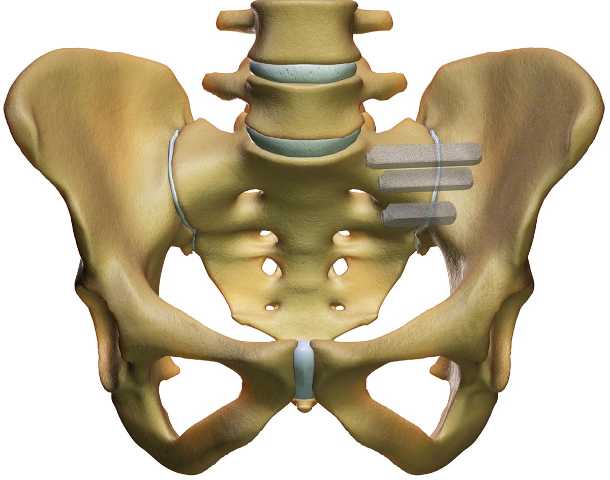 Sacroiliac Joint (SI Joint) Fusion at SAPNA: Spine and Pain Clinic of ...