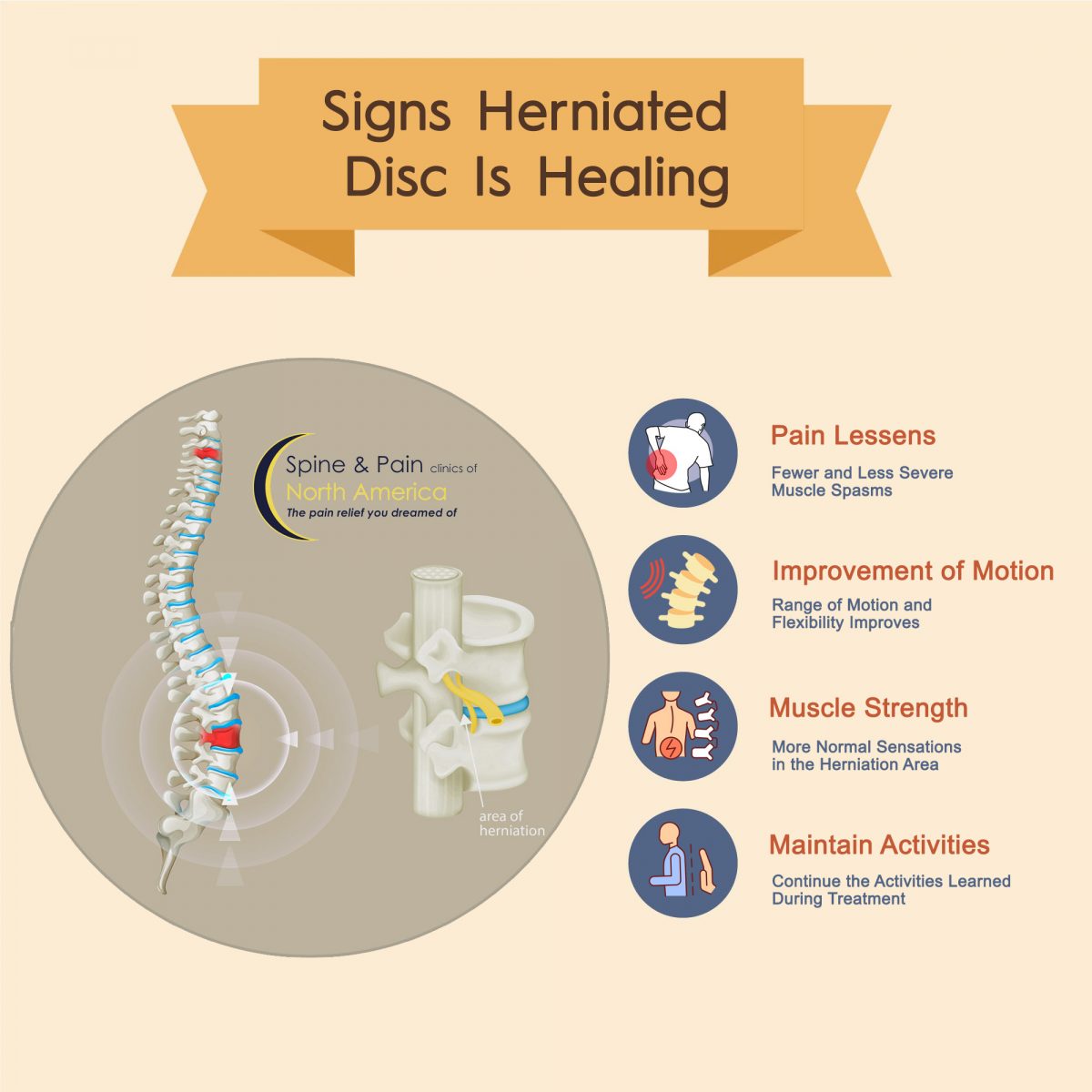 Signs Herniated Disc Is Healing – SAPNA Pain Management Blog