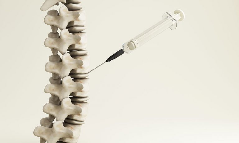 Facet Joint Injections for Pain Relief – SAPNA Pain Management Blog