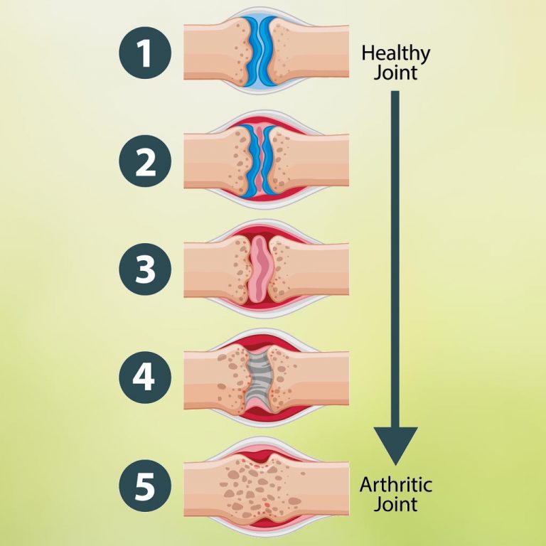 What Triggers Arthritis Flare Ups? – SAPNA Pain Management Blog